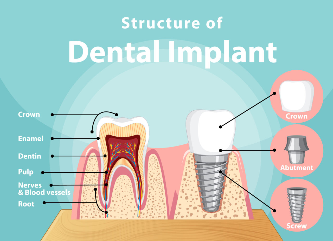 Dental Implants - Quad Dental